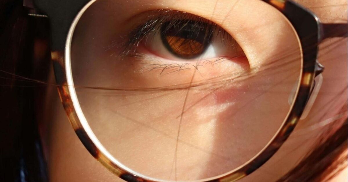 Managing Irregular Astigmatism | Eduardo Besser, MD