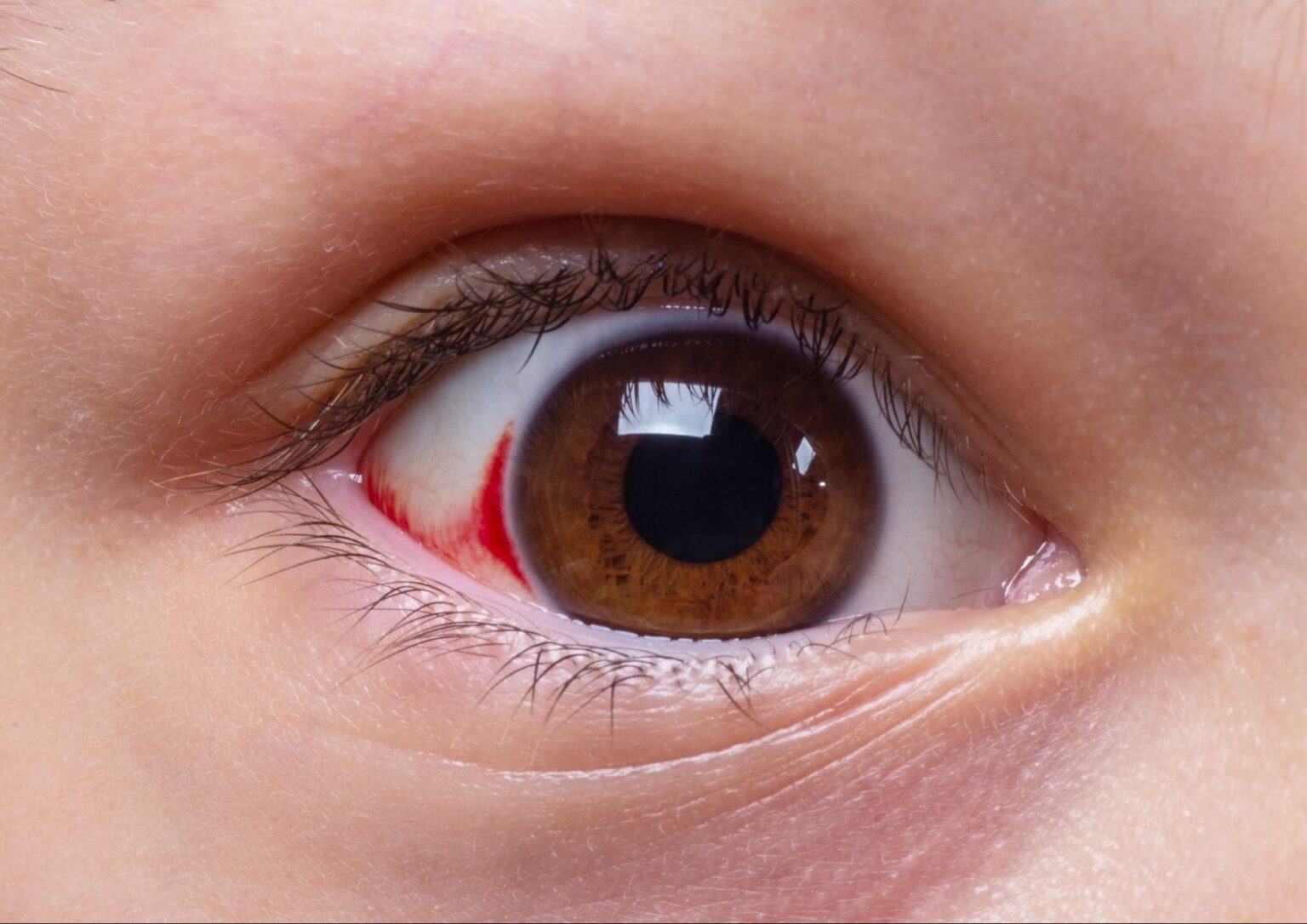Subconjunctival Hemorrhage: Symptoms & Treatments