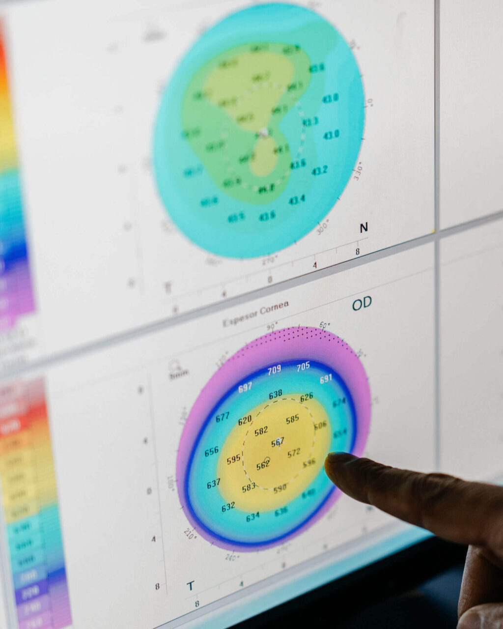 Intralase LASIK Technology | Eduardo Besser, MD