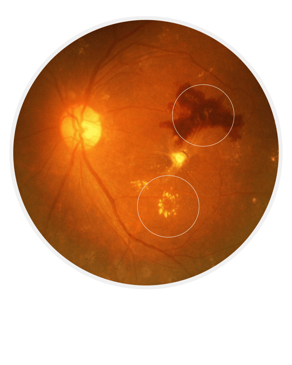 Diabetic Eye Disease Specialist | Eduardo Besser, MD