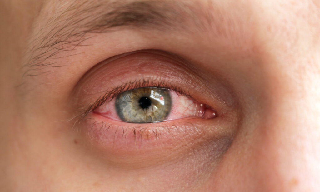 Pink Eye Symptoms & Treatment | Eduardo Besser, MD