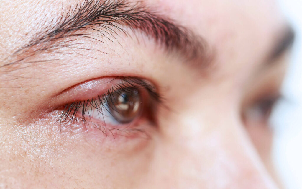 Chalazion & Stye Treatment Specialist | Eduardo Besser, MD