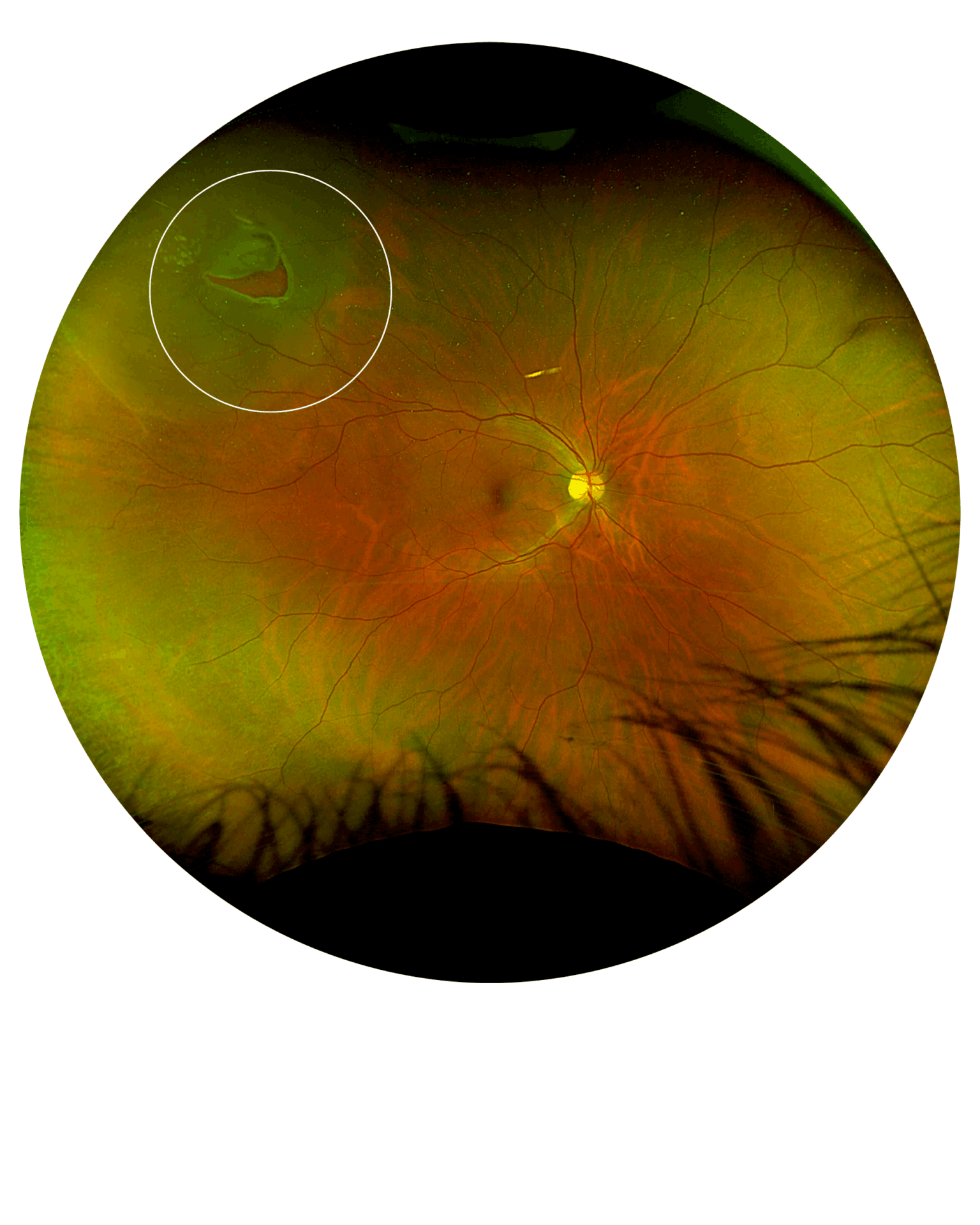 Retinal Tears Causes & Surgery | Eduardo Besser, MD