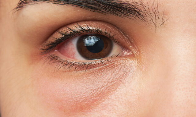 Pink Eye Symptoms & Treatment | Eduardo Besser, MD