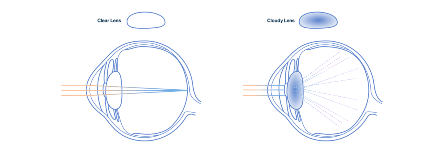 Cataracts Awareness Month | Eduardo Besser, MD