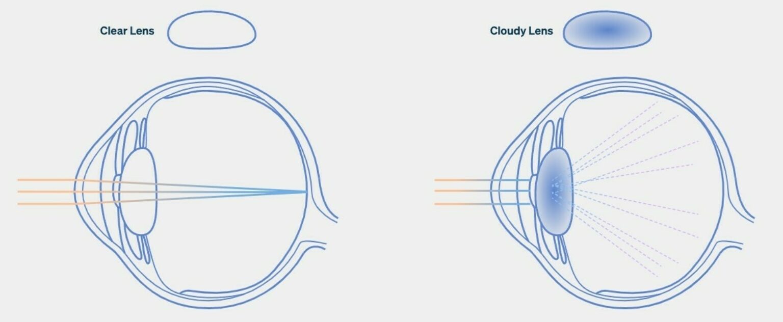 Refractive Lens Exchange vs. LASIK | Is RLE The Best Alternative?