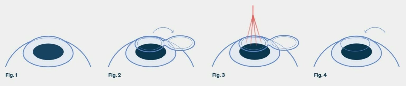 Refractive Lens Exchange vs. LASIK | Is RLE The Best Alternative?