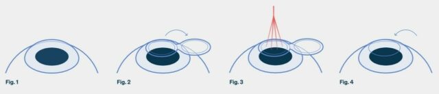 Refractive Lens Exchange vs. LASIK | Is RLE The Best Alternative?